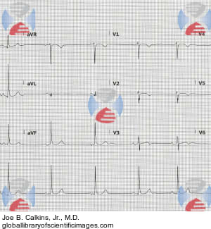 Atrial Escape Complexes | Global Library of Scientific Images
