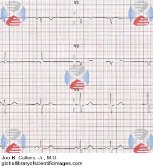 Premature Atrial Complexes | Global Library of Scientific Images