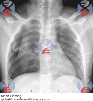 Large right pneumothorax | Global Library of Scientific Images