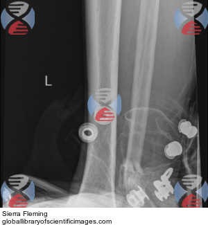 Lateral dislocation of the mid foot with mild apposition of the tibia ...