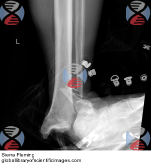 Lateral dislocation of the mid foot with mild apposition of the tibia ...