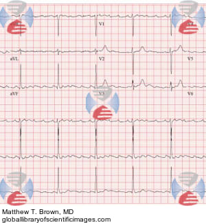 Atrial Flutter with 4 to 1 Atrioventricular Conduction | Global Library ...