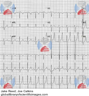 EKG -- Hyperkalemia | Global Library of Scientific Images