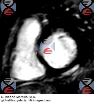 Acute Myocarditis involving basal Inferior LV wall | Global Library of ...