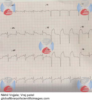 Rapidly evolving anterolateral MI | Global Library of Scientific Images