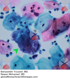 Bacterial vaginosis - Pap smear | Global Library of Scientific Images