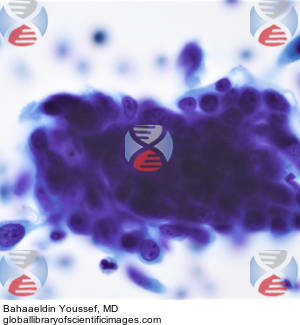 High grade squamous intraepithelial lesion of the cervix (HSIL) - Pap ...