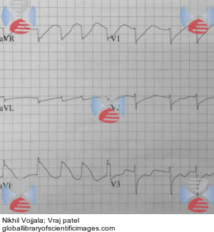 Shark Fin ECG- A deadly ECG sign..!!! | Global Library of Scientific Images