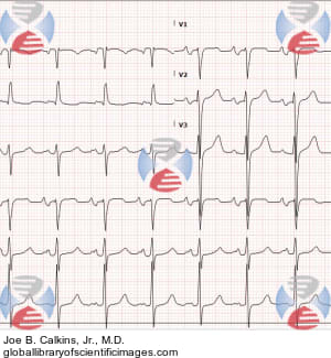 Atrial Sensing and Pacing | Global Library of Scientific Images