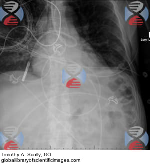 Endobronchial Dobhoff Placement | Global Library of Scientific Images