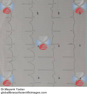 Cerebral T wave of Intracranial bleed | Global Library of Scientific Images