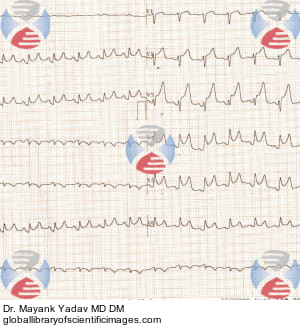 Pain of Pericarditis | Global Library of Scientific Images