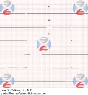 Severe SA and AV Nodal Dysfunction with a Long Ventricular Pause ...