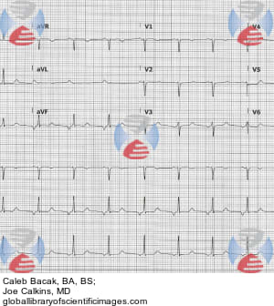 Ectopic Atrial Rhythm | Global Library of Scientific Images