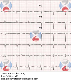 First Degree AV Block | Global Library of Scientific Images