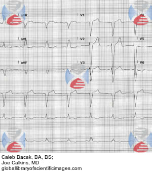 Left Bundle Branch Block | Global Library of Scientific Images