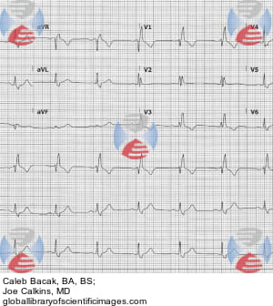 Right Bundle Branch Block | Global Library of Scientific Images