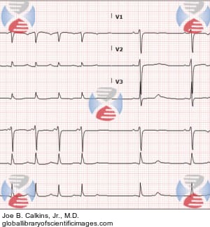 Non-sustained Atrial Tachycardia | Global Library of Scientific Images