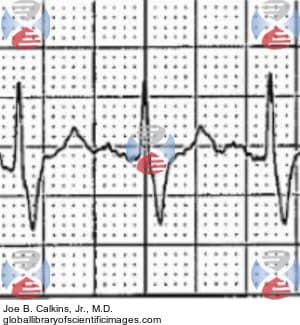 Sinus Tachycardia and Right Bundle Branch Block Recorded with an ...