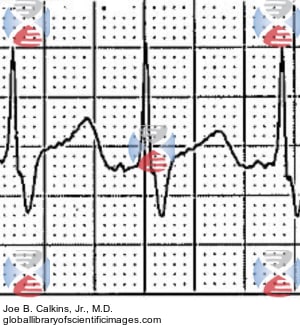 Sinus Rhythm, Non-sustained Atrial Tachycardia and Right Bundle Branch ...