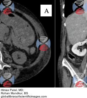 Stable perforation of Inferior Vena Cava (IVC) by the strut of an ...