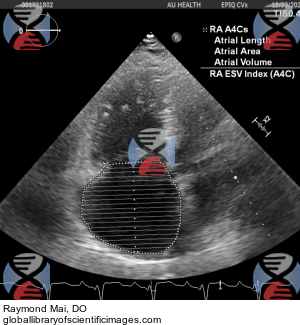 Dilated Right Atrium | Global Library of Scientific Images