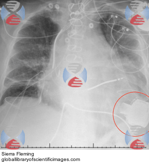Left Ventricular Assist Device (LVAD) | Global Library of Scientific Images