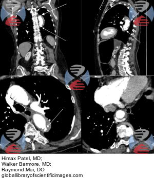 Aortic dissection with multifocal penetrating atherosclerotic ulcers ...