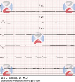 Complete Heart Block Resulting in Extreme Bradycardia | Global Library ...