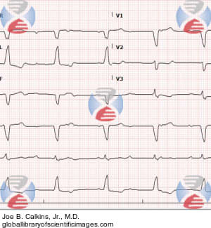 Complete Heart Block and Ventricular Pacing | Global Library of ...