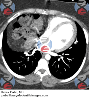 Right ventricle compression by a diaphragmatic hernia | Global Library ...