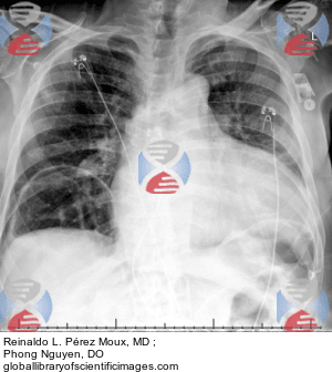 Chilaiditi's Syndrome | Global Library of Scientific Images