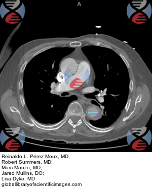 Aortic Intramural Hematoma: Labeled Axial View | Global Library of ...