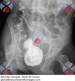 Enteric Contrast Stool Ball | Global Library of Scientific Images