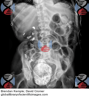 Enteric Contrast Stool Ball | Global Library of Scientific Images