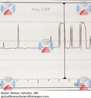 Atrial Tachycardia Heart Rate Trend | Global Library of Scientific Images