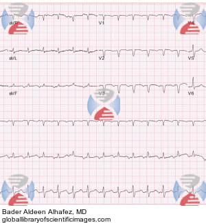Atrial Tachycardia ECG | Global Library of Scientific Images