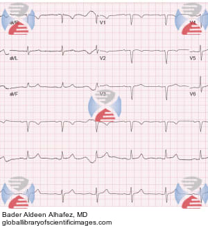 Normal Sinus Rhythm Baseline | Global Library of Scientific Images