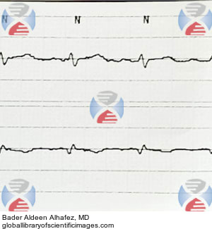 Atrial Tachycardia Telemetry Strip | Global Library of Scientific Images