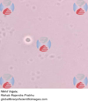 Pleural Fluid Cytology showing cryptococcus | Global Library of ...