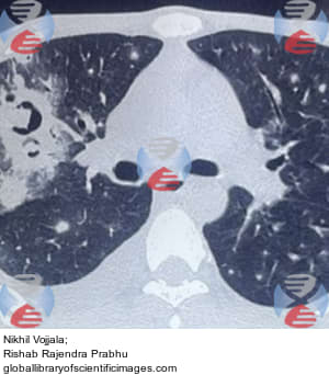 Non Contrast CT chest lung window demonstrating the Cavitating nodules ...