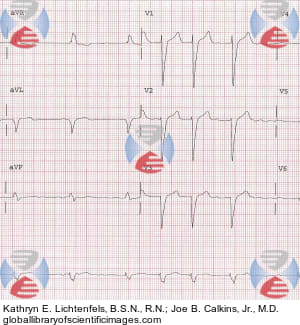 Dextrocardia, Left Bundle Branch Block and Atrial Fibrillation | Global ...
