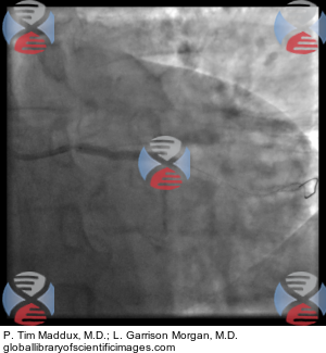 Severe Left Circumflex Stenosis with Stent Placement in the Proximal ...