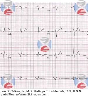 Reversal of the Left Arm and Left Leg Electrodes | Global Library of ...