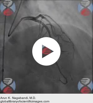 Stent Placement in the Left Anterior Descending Artery | Global Library ...
