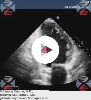 LV Thrombus | Global Library of Scientific Images