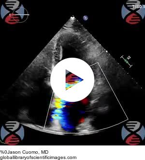 Severe mitral regurgitation, flail leaflet - TTE PLAX | Global Library ...
