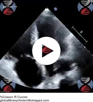 Persistent left superior vena cava | Global Library of Scientific Images