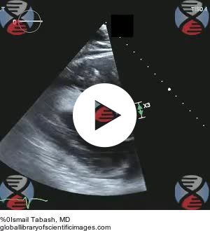 Apical thrombus | Global Library of Scientific Images