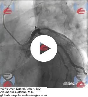Left Ventricular Angiogram | Global Library of Scientific Images
